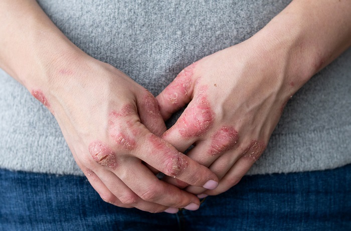 ¿Qué es la psoriasis?: 4 claves para entender la enfermedad que afecta ...